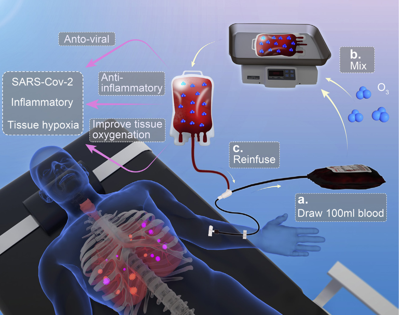 Recovery of Four COVID-19 Patients via Ozonated Autohemotherapy