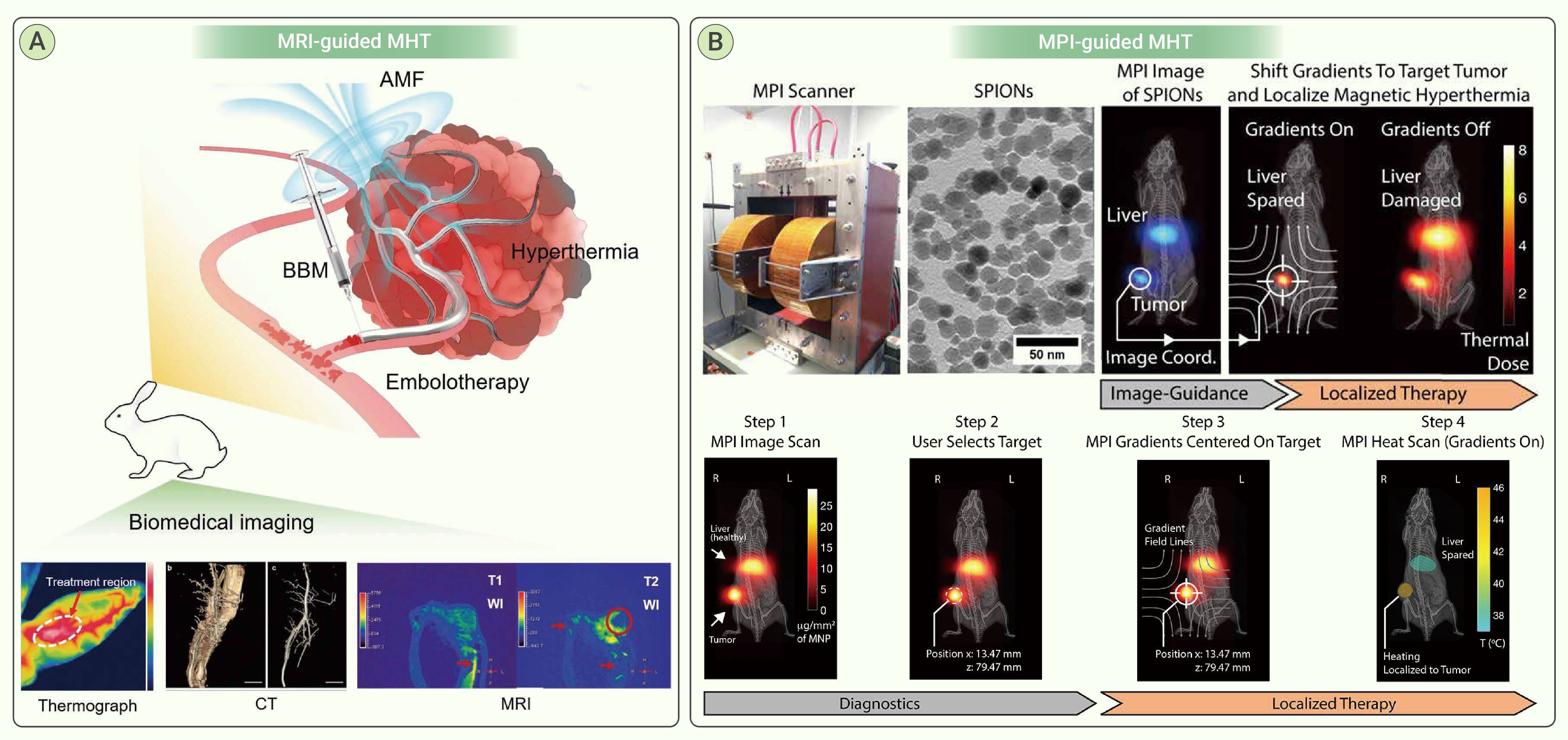 Magnetic nanoparticle-mediated hyperthermia: From heating mechanisms to cancer theranostics