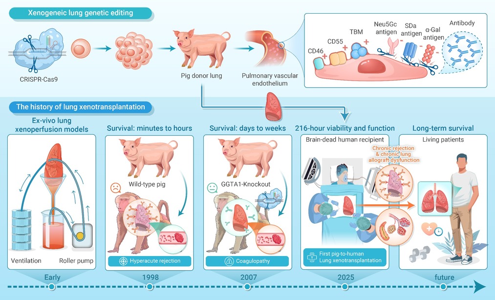 Pig-to-human lung xenotransplantation: A pioneering step toward ...